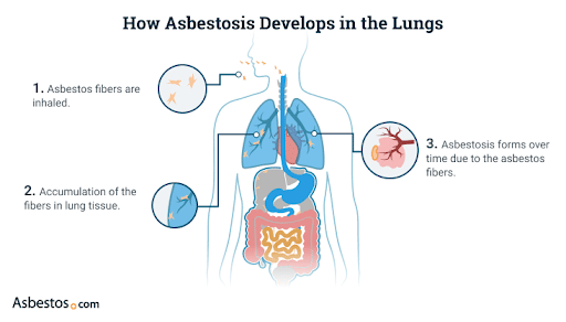 Asbestosis - Environment Notes