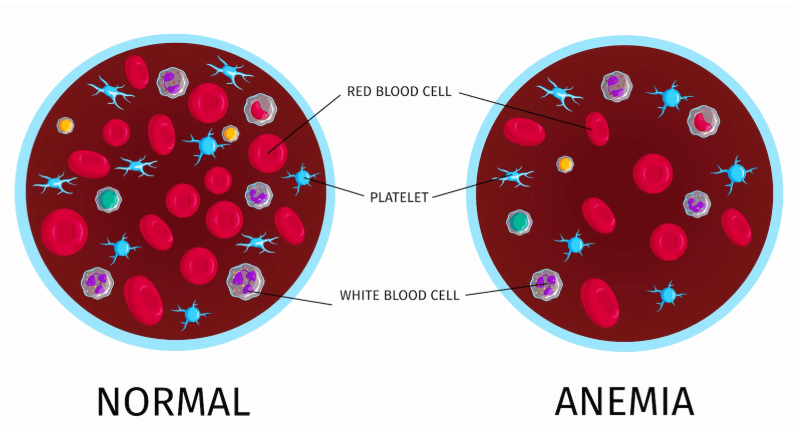 Anaemia: New Insights and Prevention Strategies